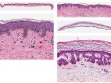 Benign Pigmented Lesions And Malignant Melanoma Plastic Surgery Key