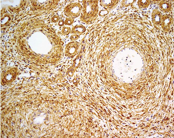 Vascular Tumors: Tumors and Tumorlike Conditions of Blood Vessels and ...