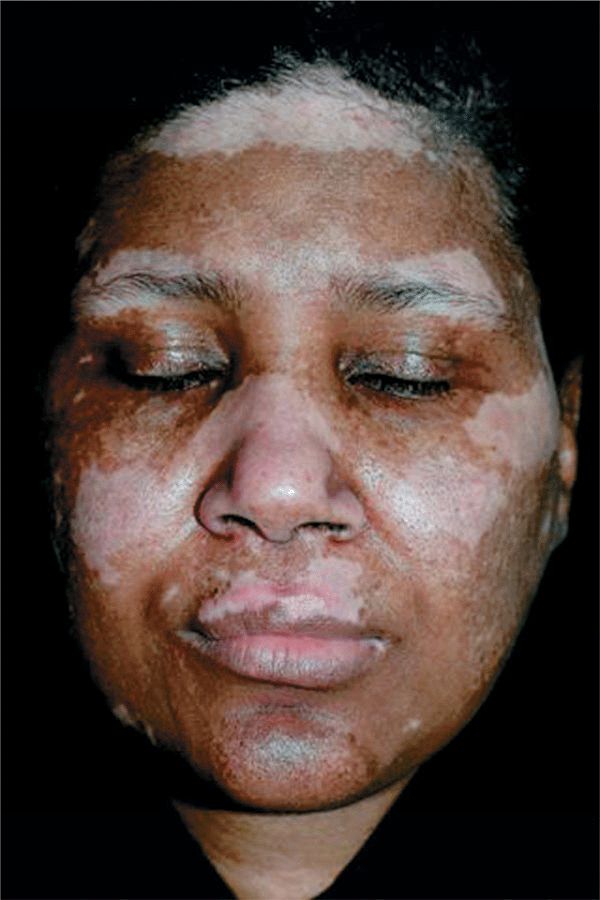 Pityriasis Alba Vs Vitiligo