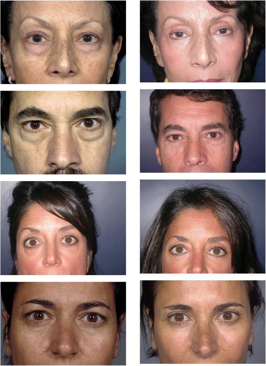 Eyebrow Anatomy | Plastic Surgery Key