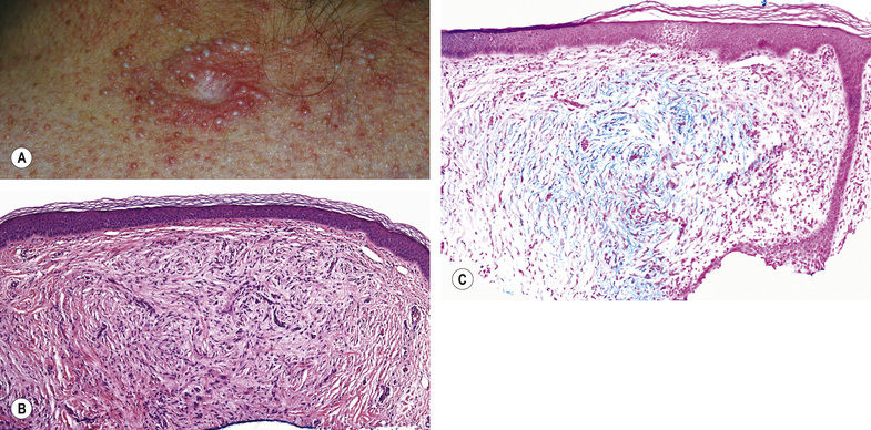 Small Papules Secondary to a Dermal Process | Plastic Surgery Key