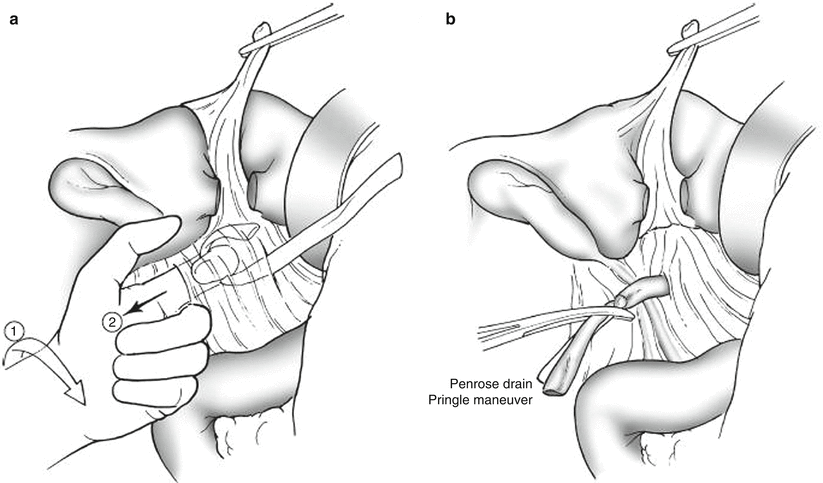 Liver And Extrahepatic Bile Ducts Plastic Surgery Key