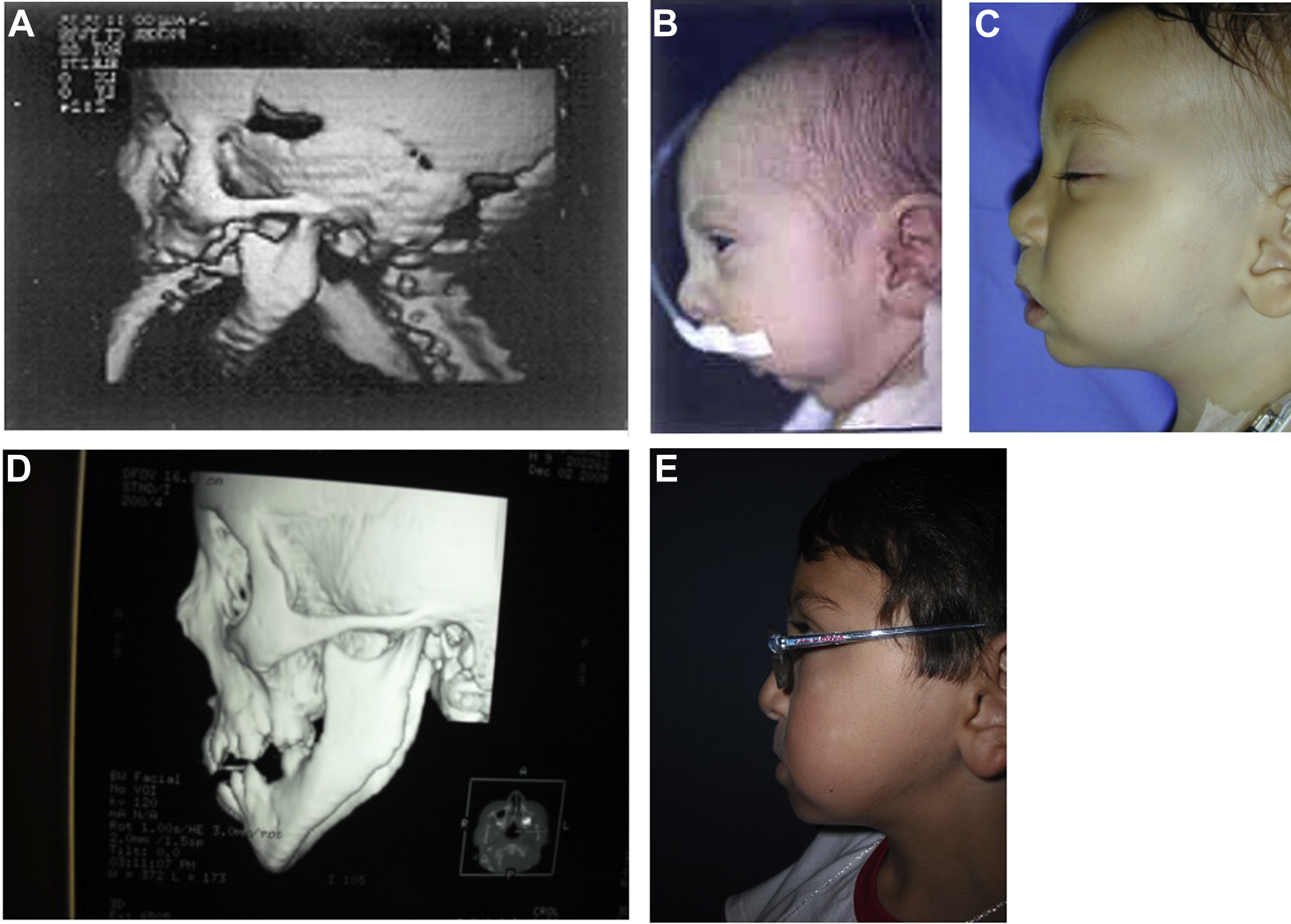Robin Sequence | Plastic Surgery Key