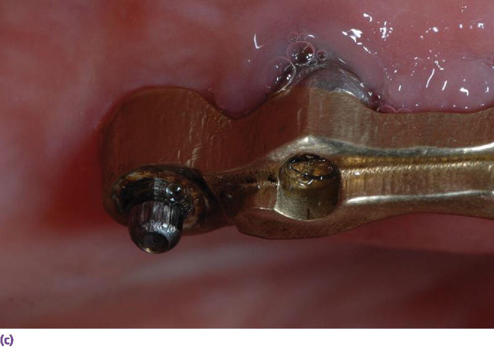 17: Implant Restoration of the Maxillary Edentulous Patient | Pocket ...