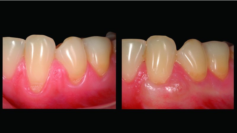 Management of Gingival Recession and Graft Harvesting | Pocket Dentistry