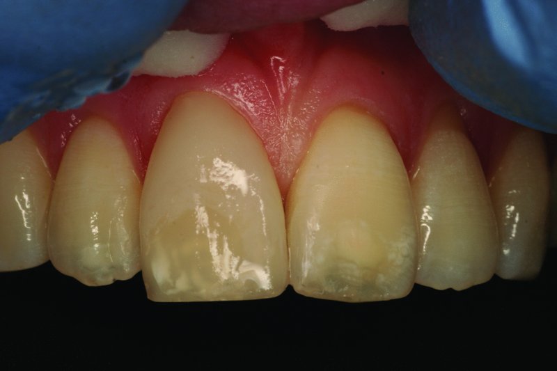 Anterior Restorations | Pocket Dentistry
