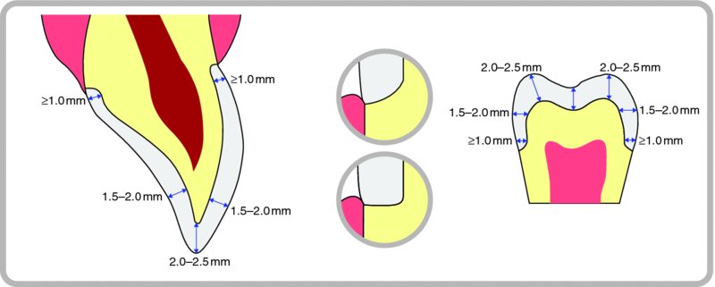 Tooth Preparation for Full Coverage Restorations | Pocket Dentistry