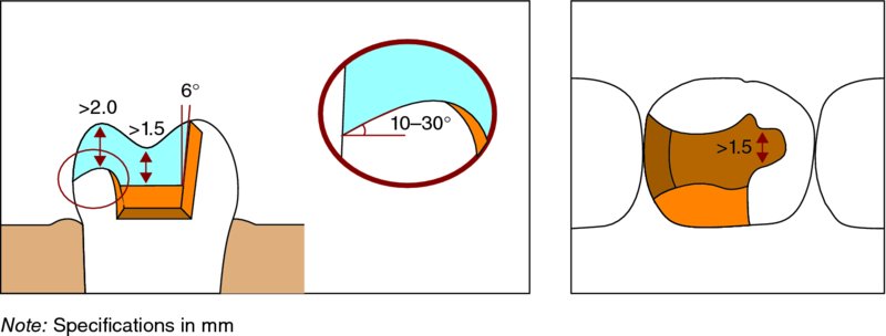 Tooth Preparation for Partial Coverage Restorations | Pocket Dentistry