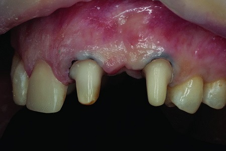 Adhesive Bridges | Pocket Dentistry