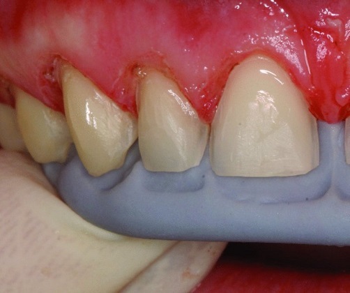 Tooth Preparation for Porcelain Laminate Veneers | Pocket Dentistry