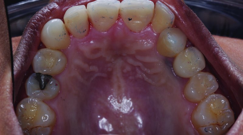 Maxillary Anterior Direct Build-up with Indices | Pocket Dentistry