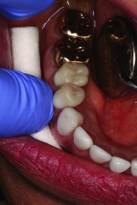 Evaluation and Management of the Occlusal Vertical Dimension ...