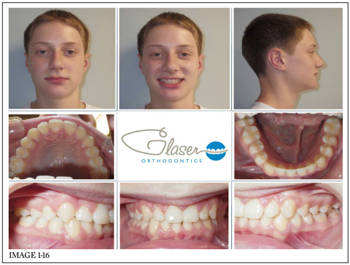 of Invisalign Treatment Planning | Pocket Dentistry