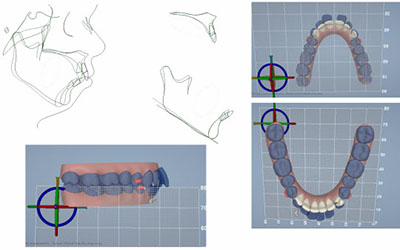and Severe Crowding Class I Cases | Pocket Dentistry