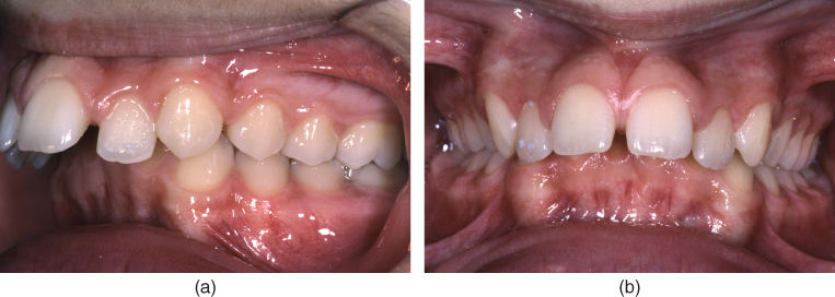 Classification of malocclusions | Pocket Dentistry