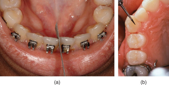 Crowding of teeth | Pocket Dentistry