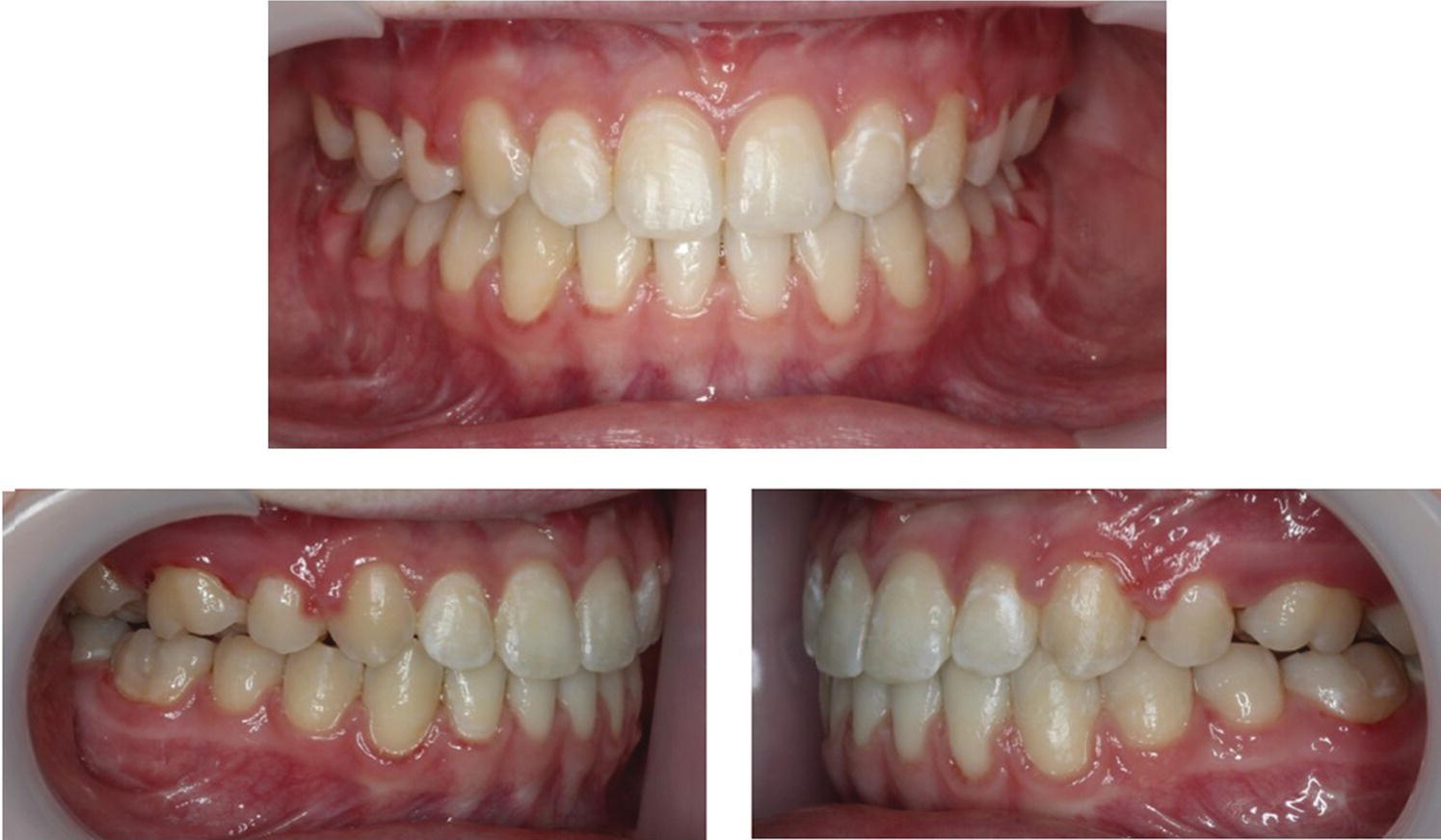 Treatment for Class III Malocclusion | Pocket Dentistry