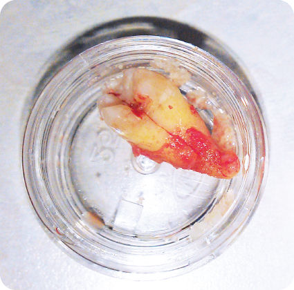 Diagnostic Case I: Tooth Fracture: Unrestorable | Pocket Dentistry