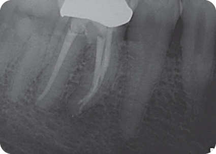Perio–Endo Interrelationships | Pocket Dentistry