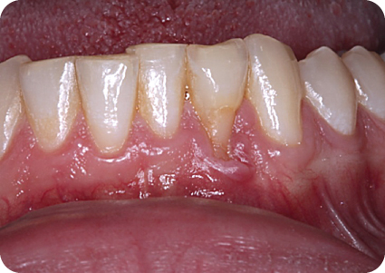 External/Internal Resorption | Pocket Dentistry