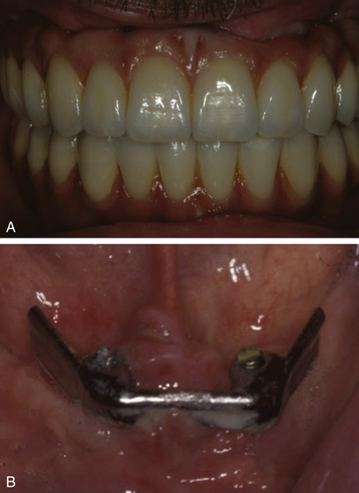 Ideal Implant Positioning | Pocket Dentistry