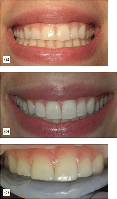 The Importance of Occlusion and Occlusal Diagnosis in Restorative ...
