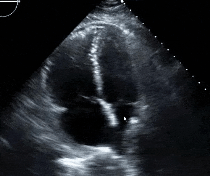 dilated-rv | POCUS BASICS .org