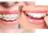 Brackets Transparentes Vs Invisalign