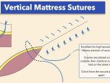 Wound Closure Techniques