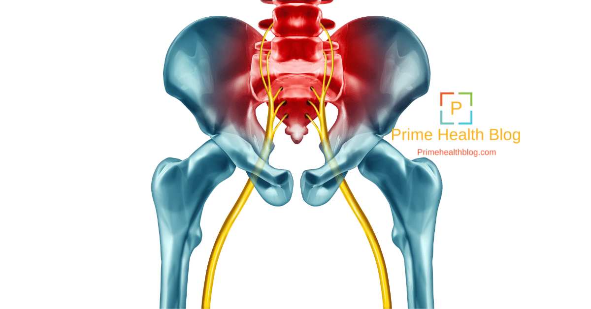 Understand The Background Of sciatica with its symptoms-causes. » Prime ...