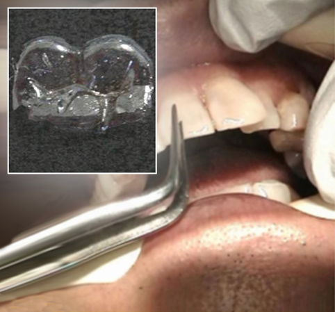 Japanese Scientists Develop Ultrathin Tooth Patch - PreScouter - Custom ...