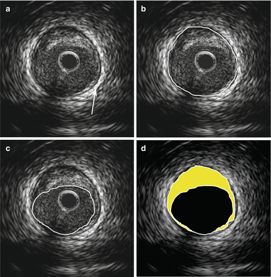 Cardiac Imaging in Clinical Trials | Radiology Key