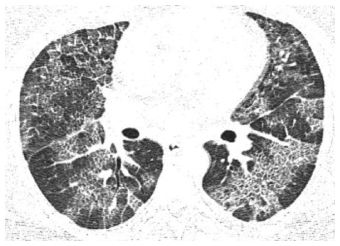 Pulmonary Edema, Diffuse Alveolar Damage, the Acute Respiratory ...