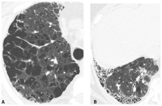 Smoking-Related Lung Disease | Radiology Key