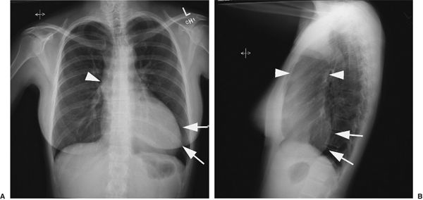 Chest | Radiology Key