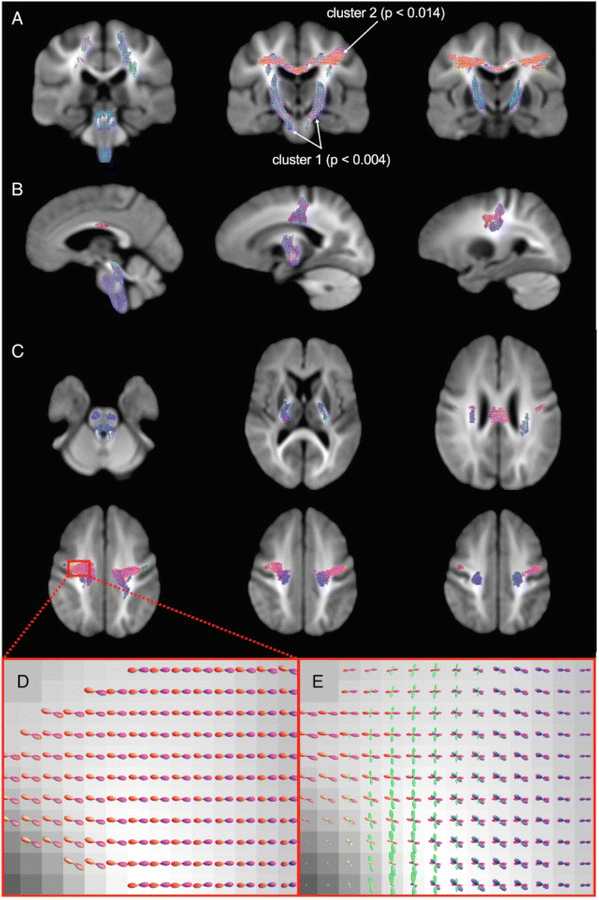 High Angular Resolution Diffusion Imaging | Radiology Key