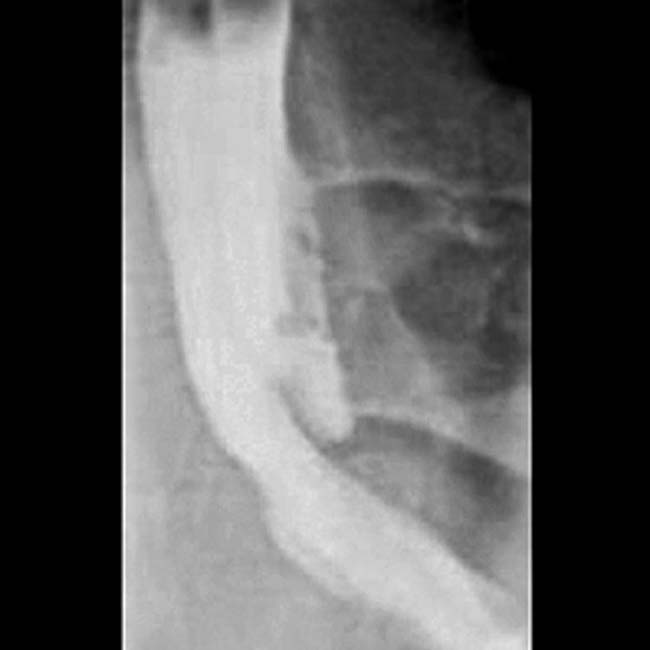 Boerhaave Syndrome | Radiology Key