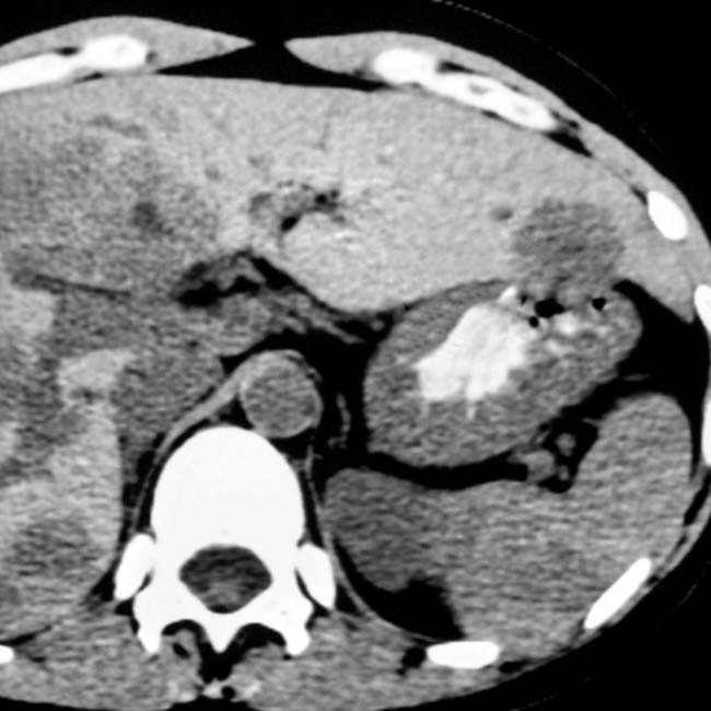 Zollinger-Ellison Syndrome | Radiology Key