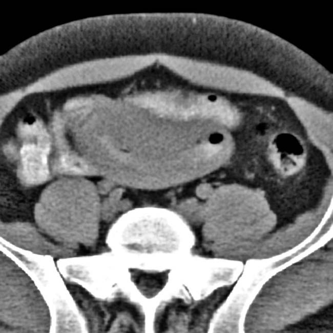 Intestinal Metastases and Lymphoma | Radiology Key