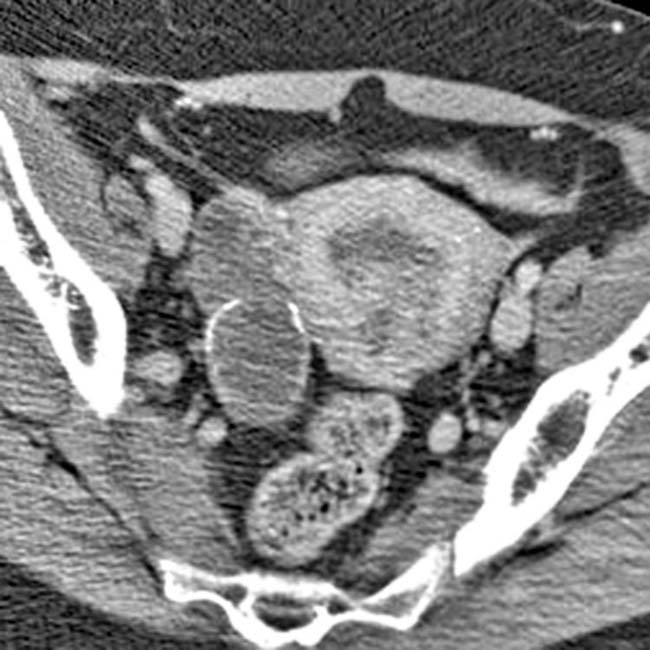 Mucocele of the Appendix | Radiology Key