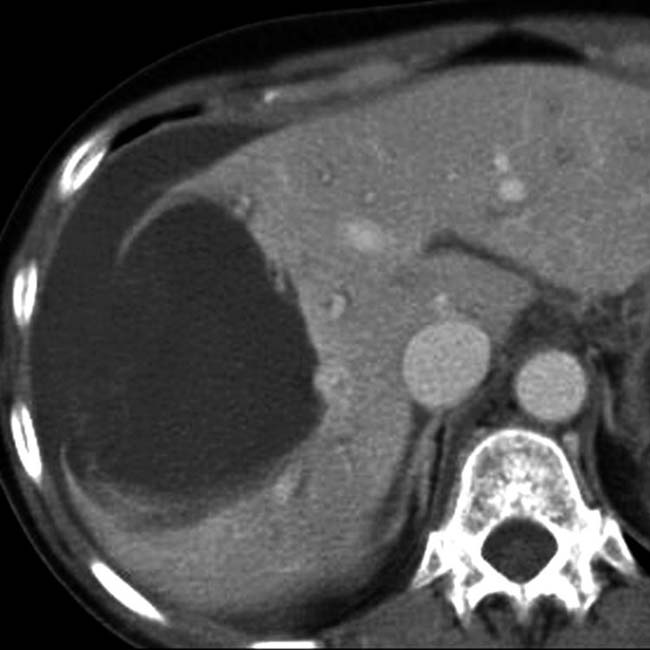 Hepatic Cyst | Radiology Key