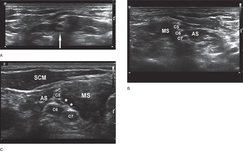 Additional Ultrasound-Guided Procedures | Radiology Key