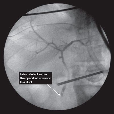 Gallbladder | Radiology Key