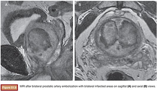 Benign Prostatic Hyperplasia | Radiology Key