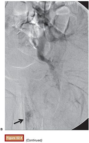 Priapism | Radiology Key