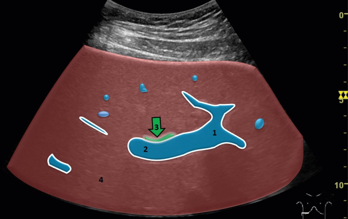 vein bifurcation | Radiology Key