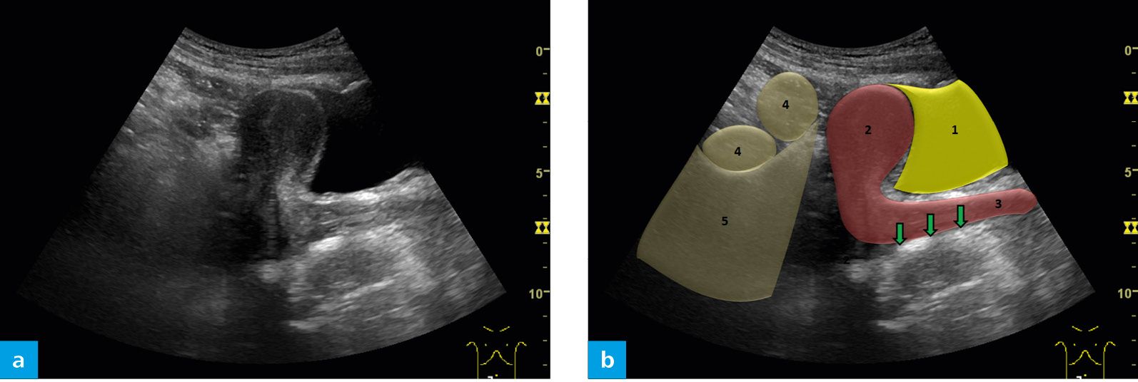 Bladder | Radiology Key