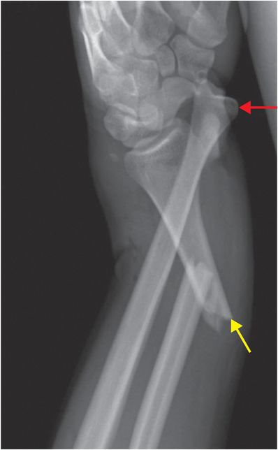 70 23-year-old female with visible deformity of the forearm following a ...