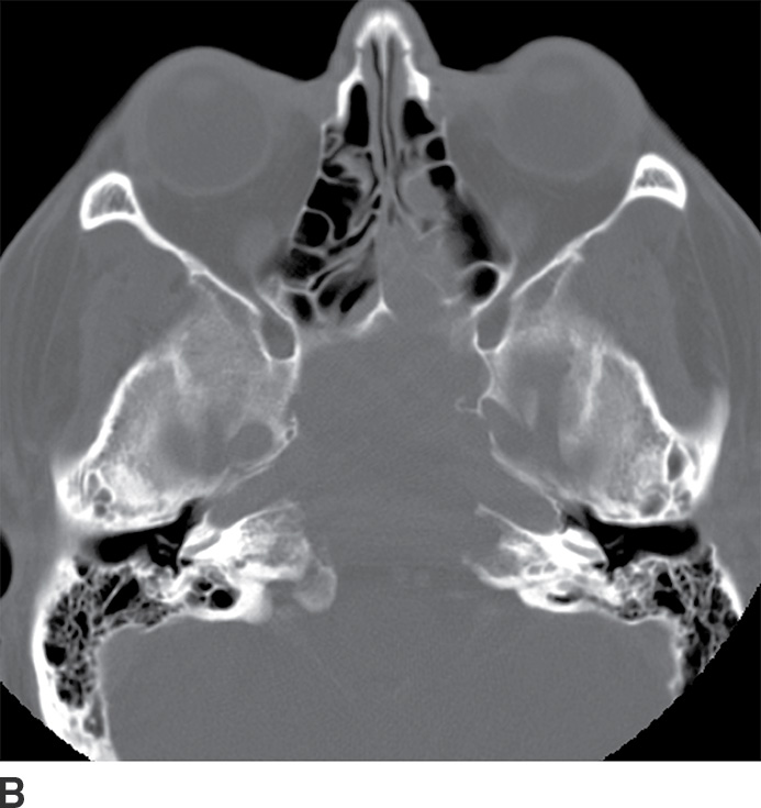 Ventral and Central Skull Base: Sinonasal, Sellar, Parasellar, and ...