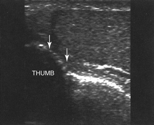 Male Pelvis Scanning Protocol for the Prostate Gland, Scrotum, and ...